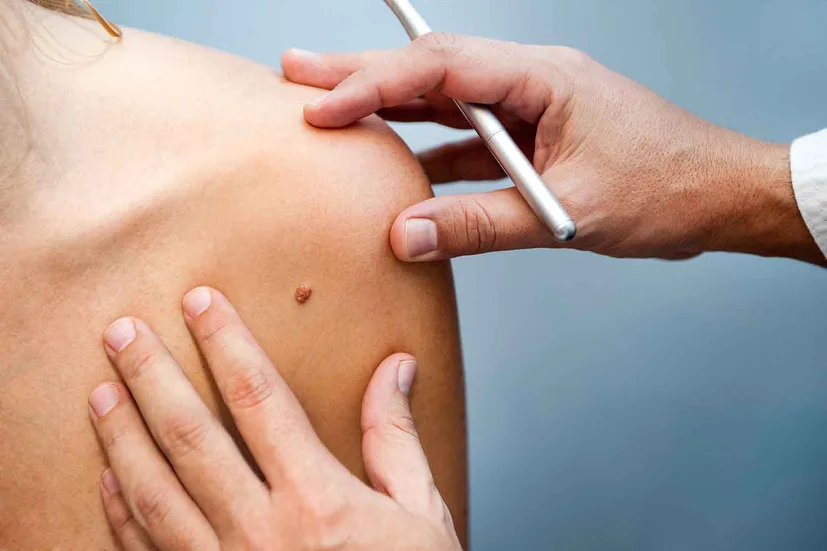 What you can do about that annoying hairy mole
