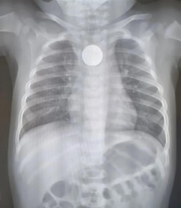 Parents' warning: Our daughter swallowed a button battery | that's life!