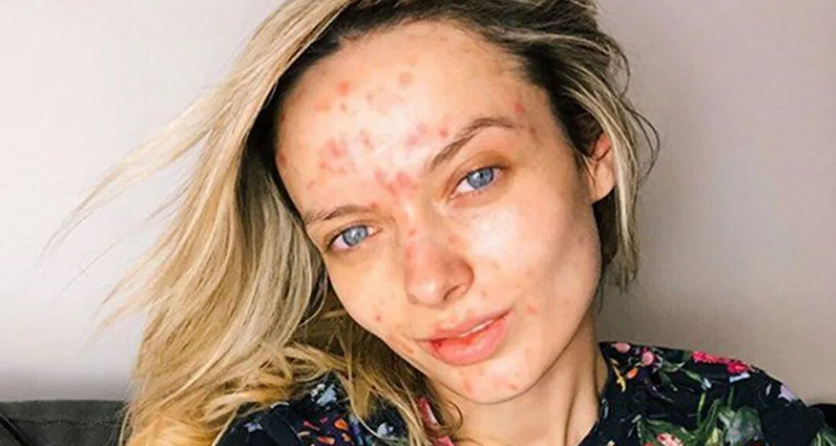 Instagram influencer Em Ford fights back at acne-shaming | that's life!