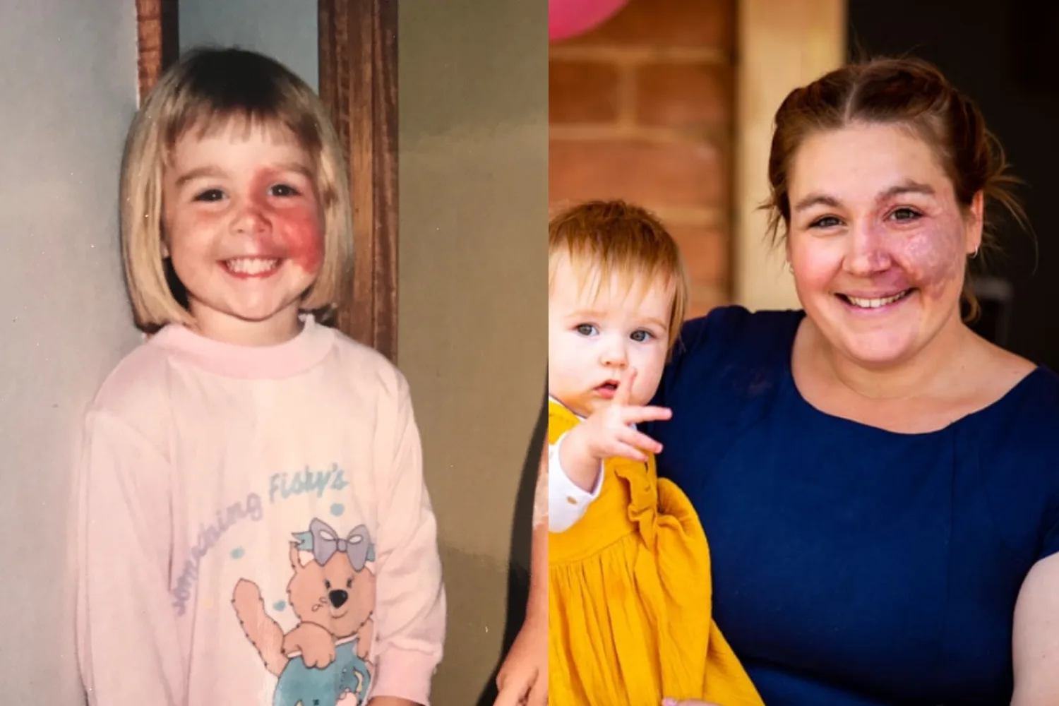 Adelaide mum Kristen Weber-Moll born with port wine stain is proud of ...