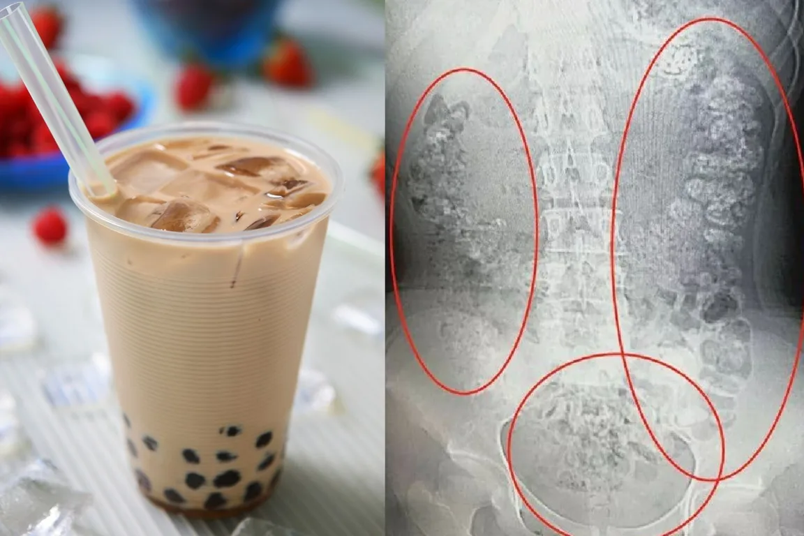Hundreds of bubble tea balls stuck in girl's stomach | that's life!