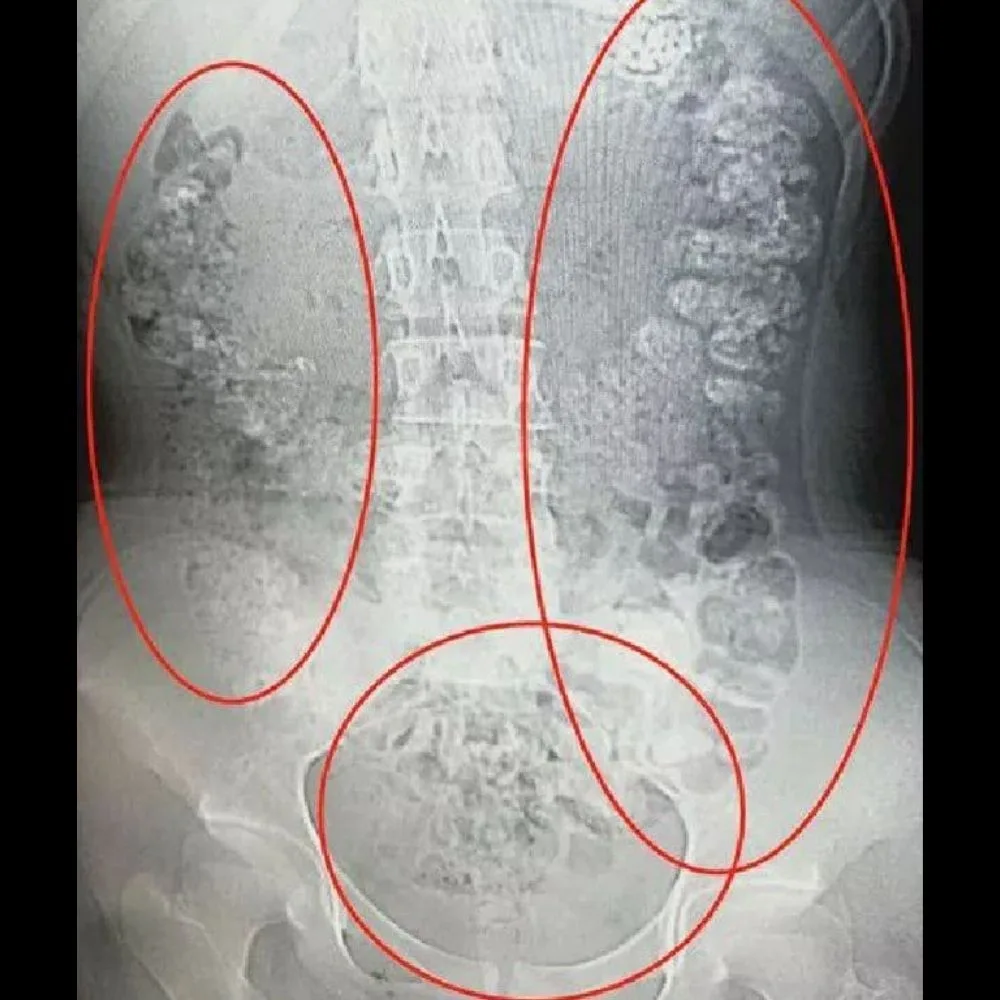 Hundreds of bubble tea balls stuck in girl's stomach | that's life!