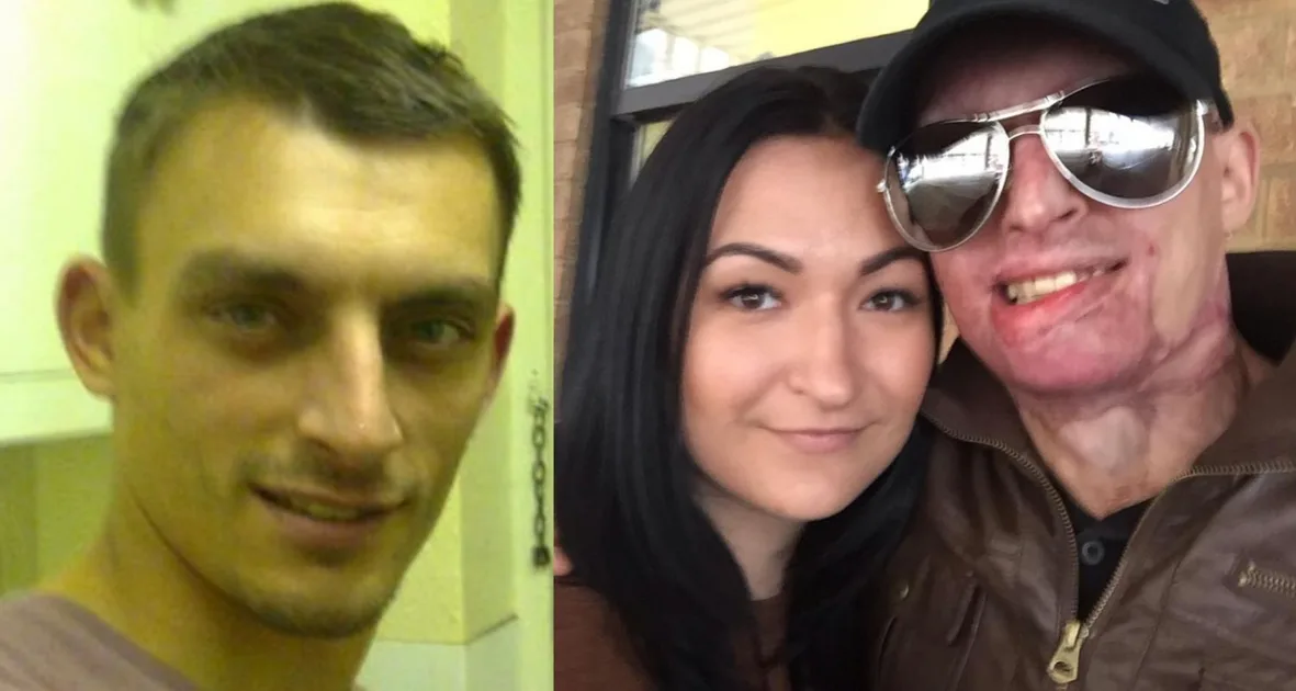 Daniel was savagely doused in acid by his exil ex...but then found love ...