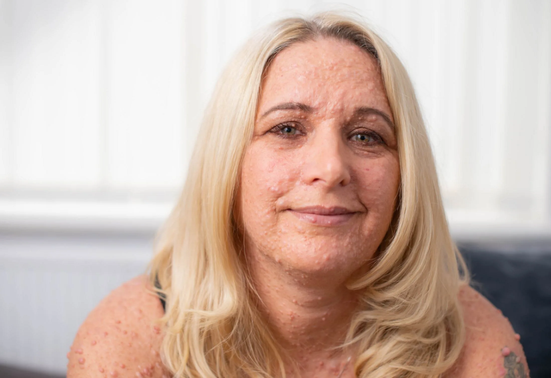 My ‘bubble’ skin won’t stop me! | that's life!