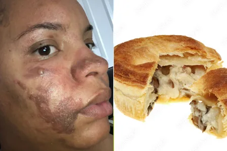 Woman suffers burns and scarring after attack by pie at the races ...