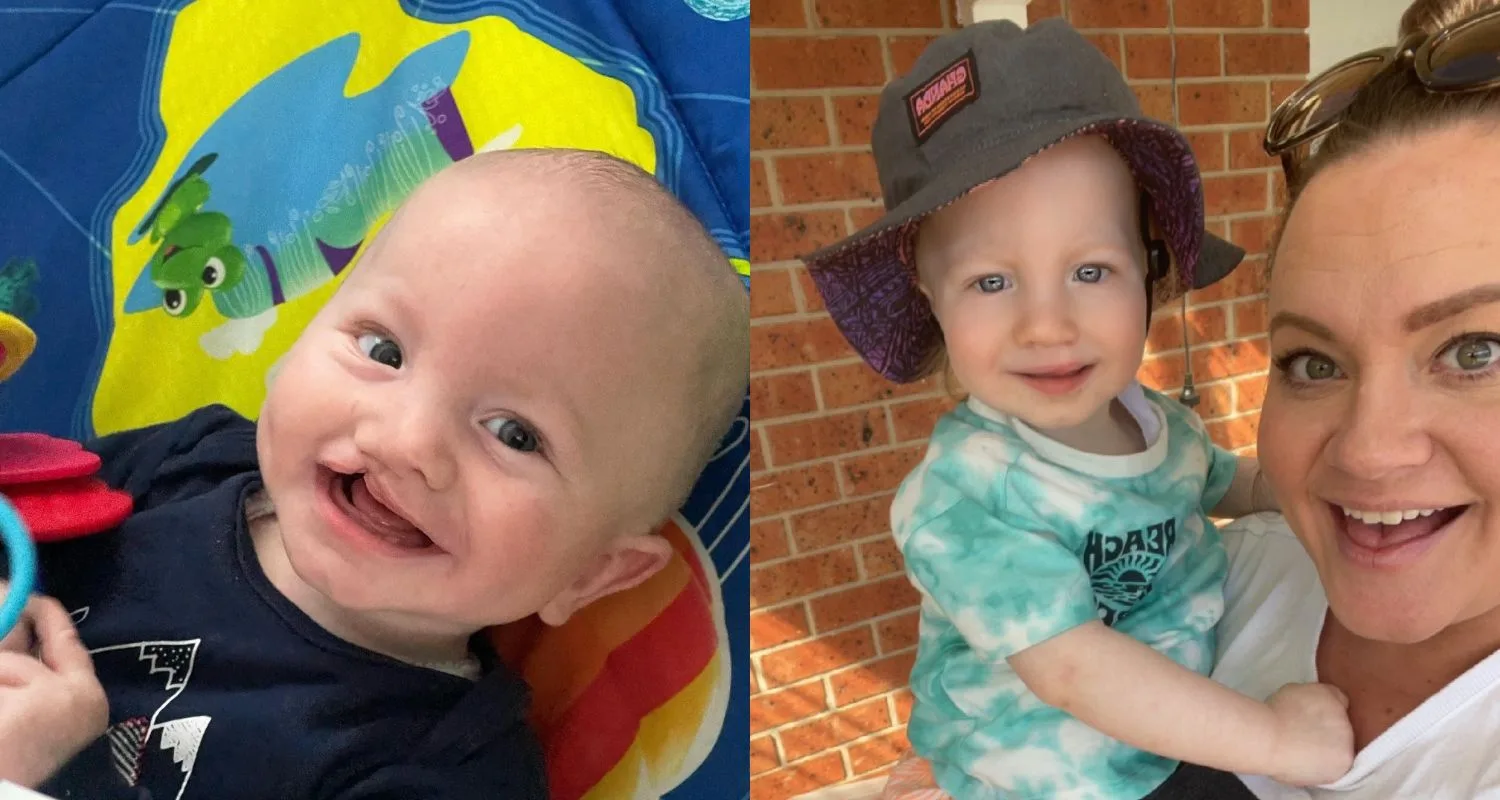 Born with a cleft lip, my miracle baby now has his forever smile!| that ...