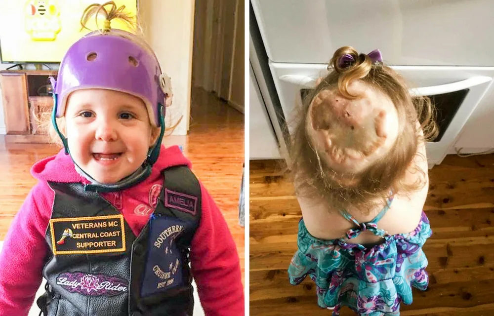 Mum with baby 'born with half a head' shares incredible story | that's ...