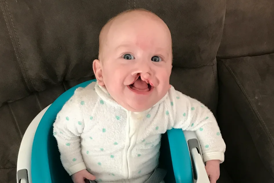 Born with a severe cleft lip and palate baby undergoes transformation ...