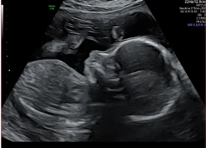 James Tobin and wife Farrah are expecting a baby