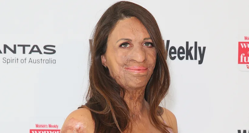 Turia Pitt shares recovery photos from latest surgery | WHO