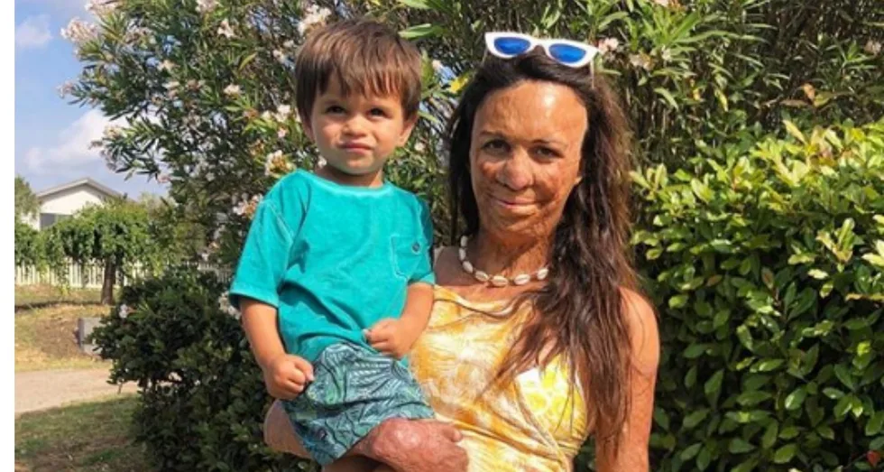 Turia Pitt praised for leading new bushfire campaign | WHO