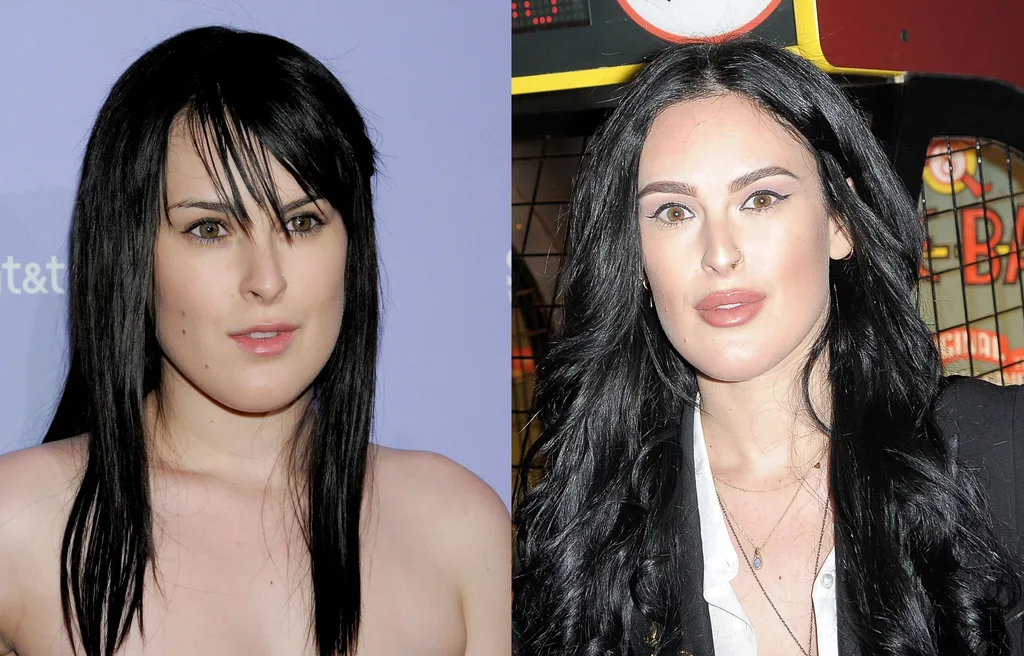 Rumer Willis steps out with fuller lips | WHO