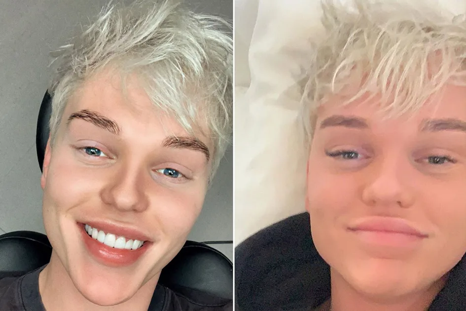 Jack Vidgen has had his veneers redone | Girlfriend