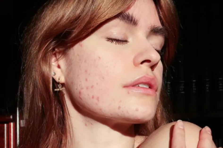 Is your skin freaking out right now? Here's why | Girlfriend