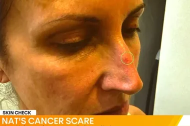 Natalie Barr reveals skin cancer diagnosis | New Idea