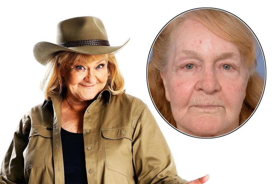 Val Lehman shows off her facial rejuvenation surgery | New Idea