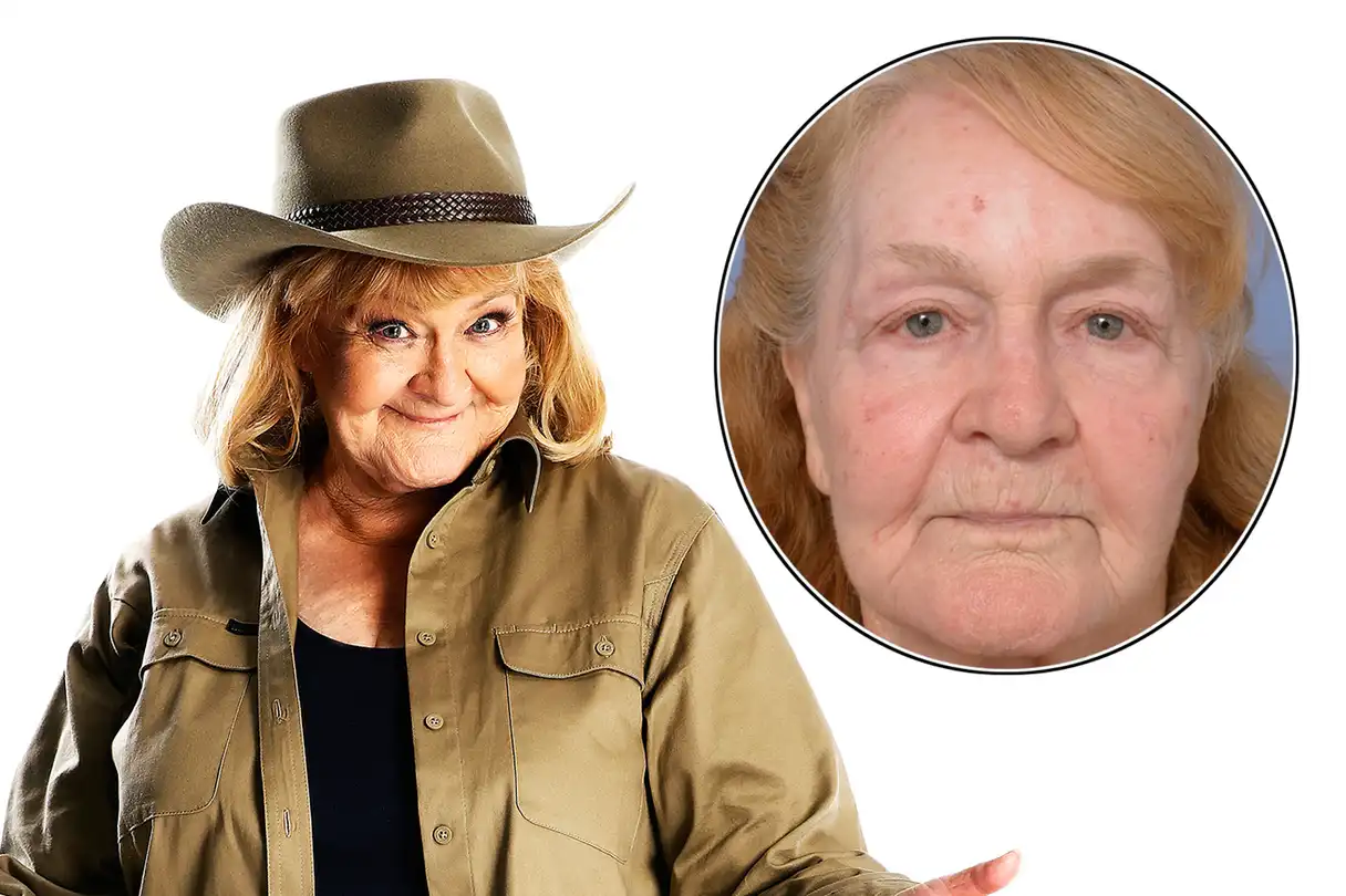 Val Lehman shows off her facial rejuvenation surgery | New Idea