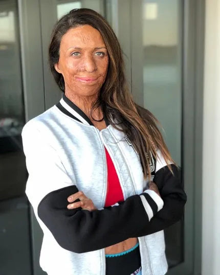 Turia Pitt undergoes surgery | New Idea
