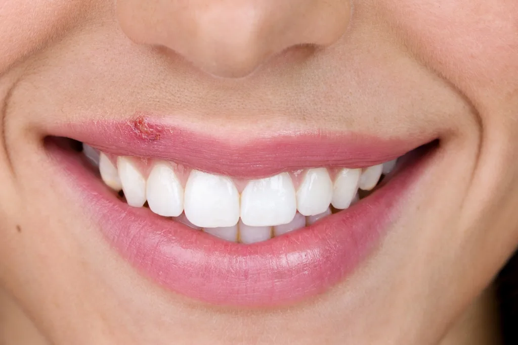 How to treat cold sores | New Idea