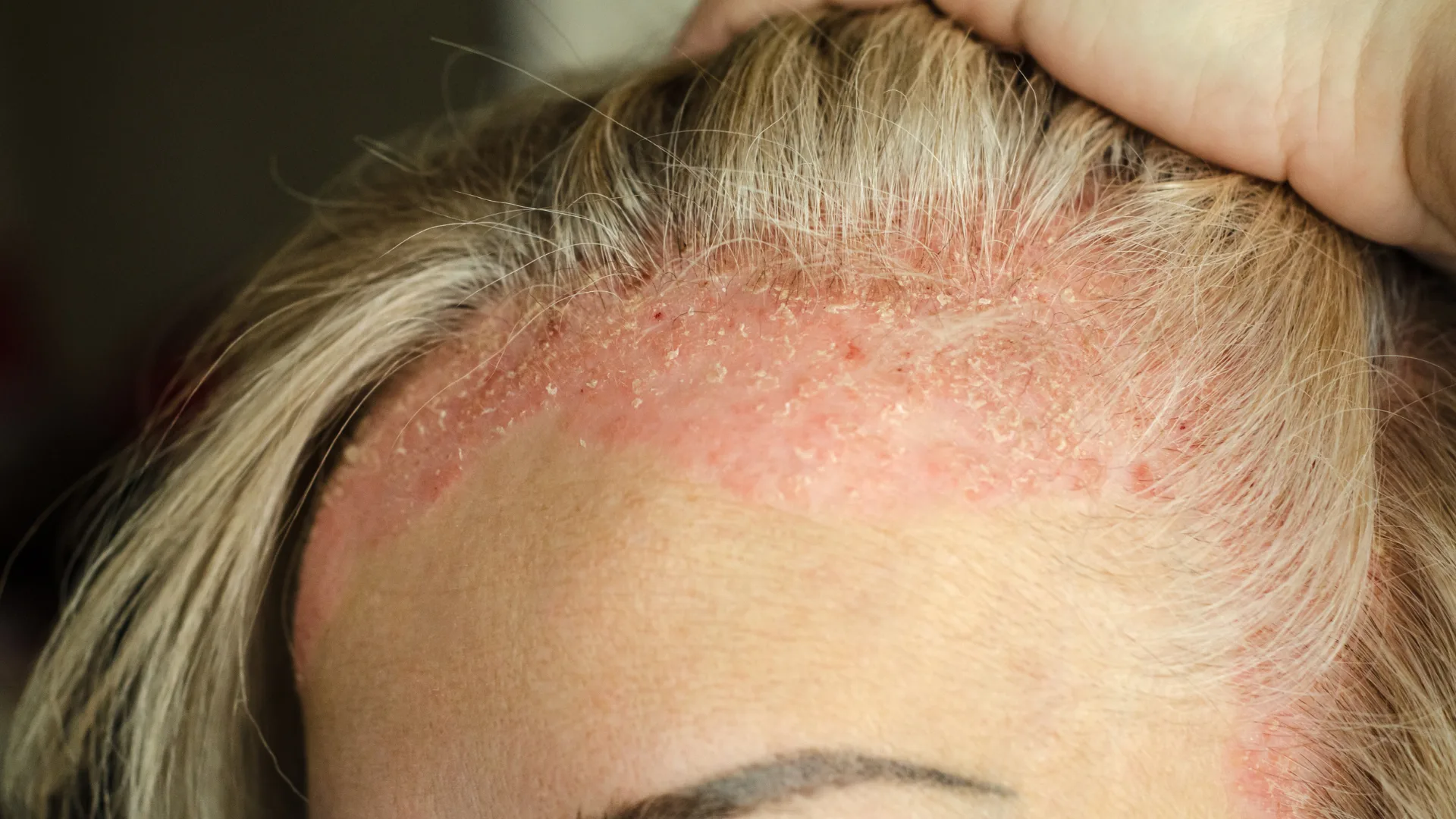 The expert guide to managing seasonal skin flare-ups - The Australian ...