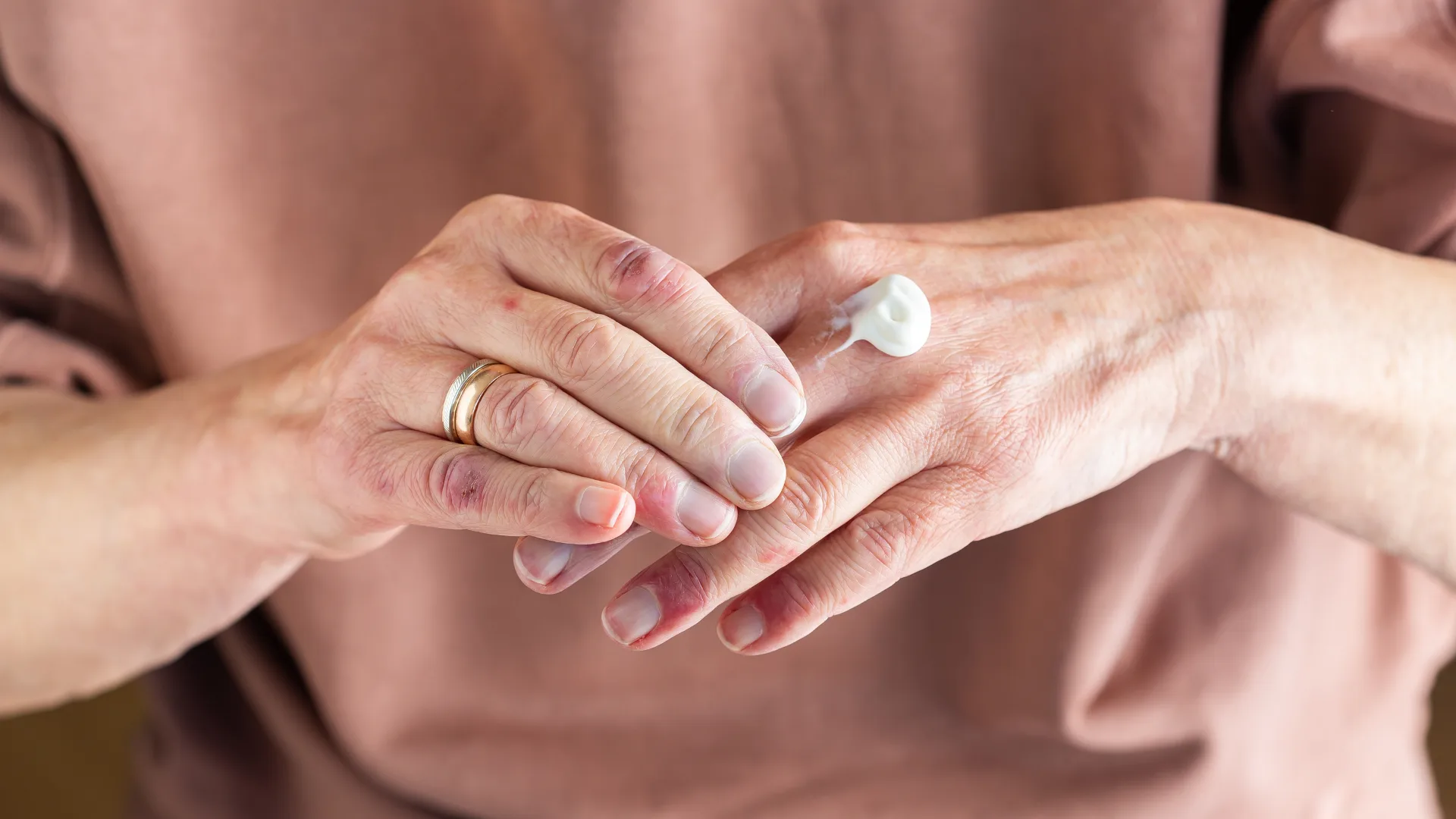 The expert guide to managing seasonal skin flare-ups - The Australian ...