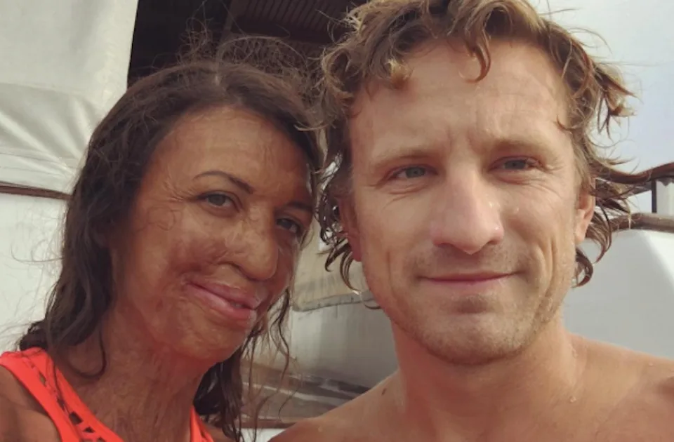 Turia Pitt to start an inspirational blog