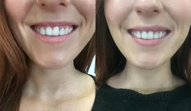 Lip Flip Review: Better Than Lip Filler for Plump Pout? | ELLE
