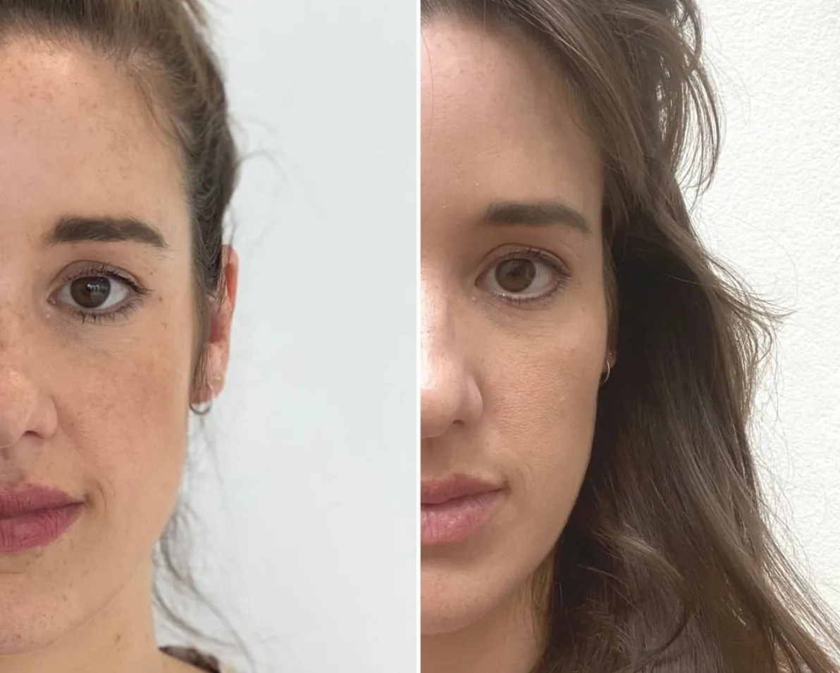 Cheek Filler Before And After: What To Know & What It's Like