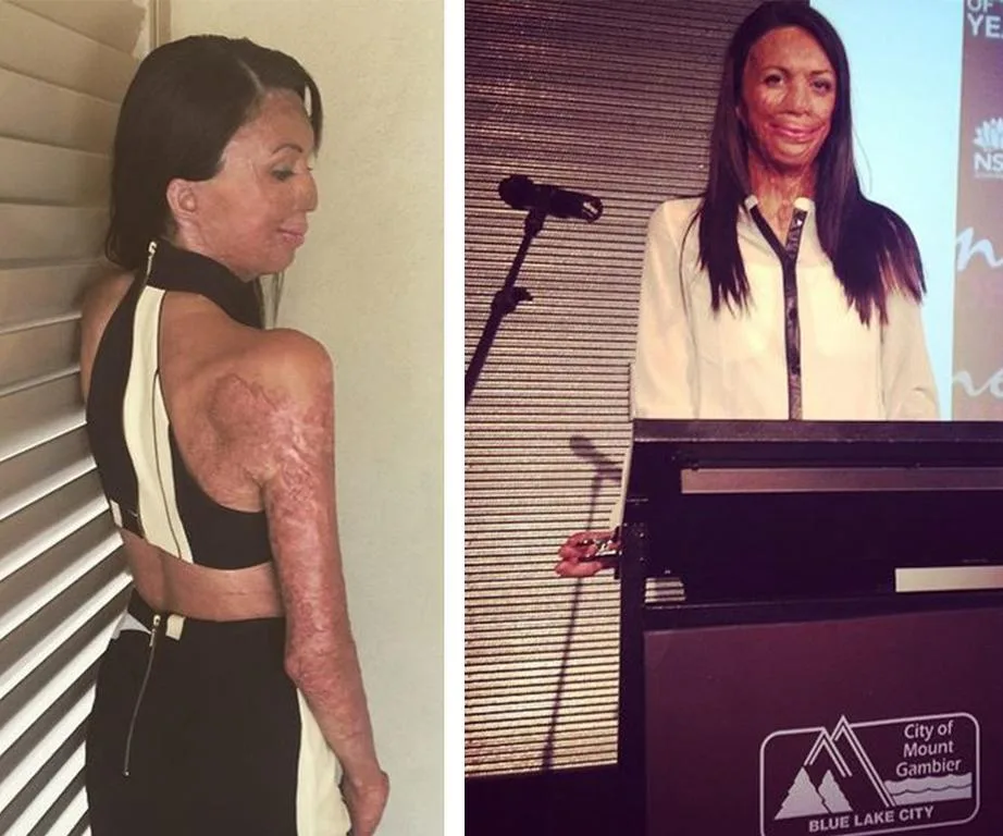 Turia Pitt inspirational moments