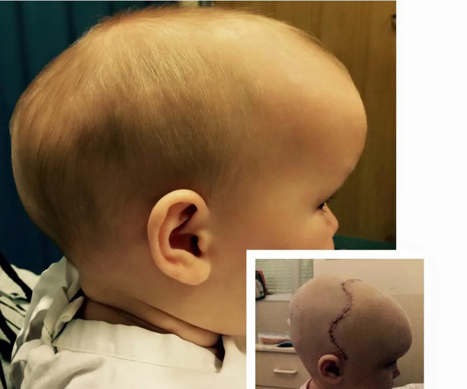 Baby born with craniosynostosis had football shaped head
