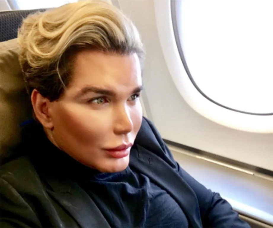 ‘Human Ken’ Rodrigo Alves face “peeled off in lumps”