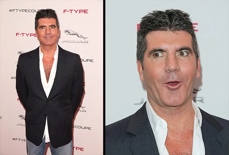 Simon Cowell's botched Botox?