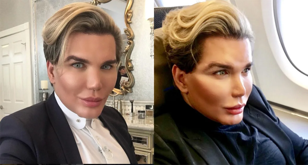 ‘Human Ken’ Rodrigo Alves is getting his 10th nose job