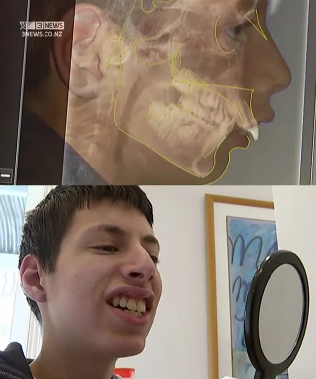 Buck-toothed boy gets a smile makeover