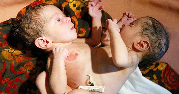 Woman discharges self hours after naturally giving birth to conjoined twins