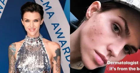 Ruby Rose opens up about her struggle with adult acne