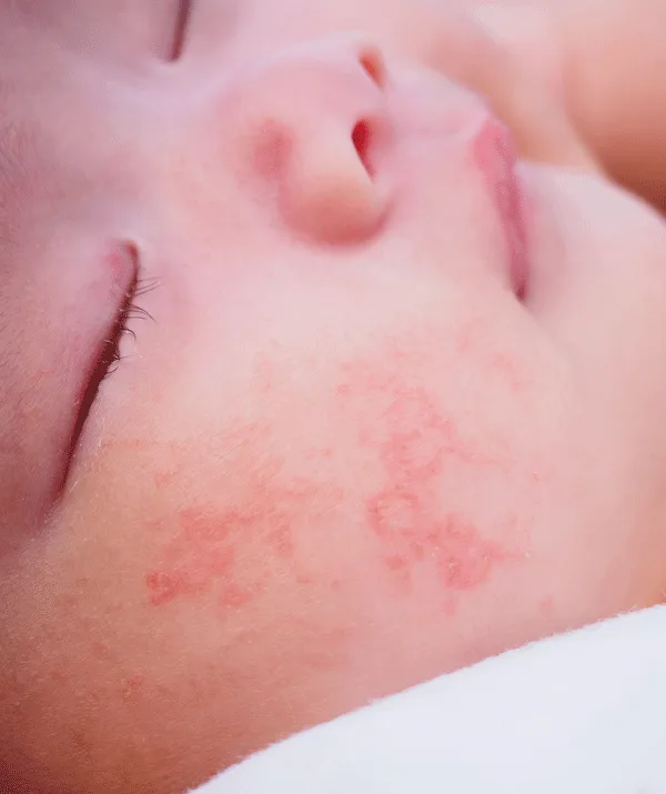 Baby heat rash: How to treat and prevent it