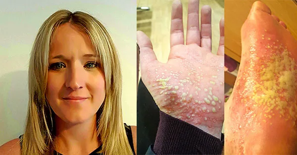 Psoriasis made my skin fall off