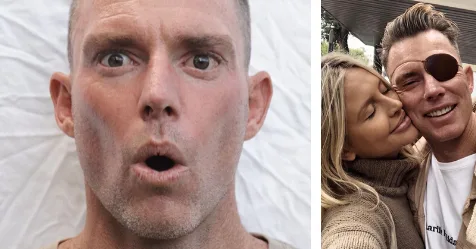 MKR's friendly pirate Ash Keillah reveals his new eyeball