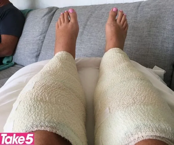 IPL laser treatment left me with second-degree burns