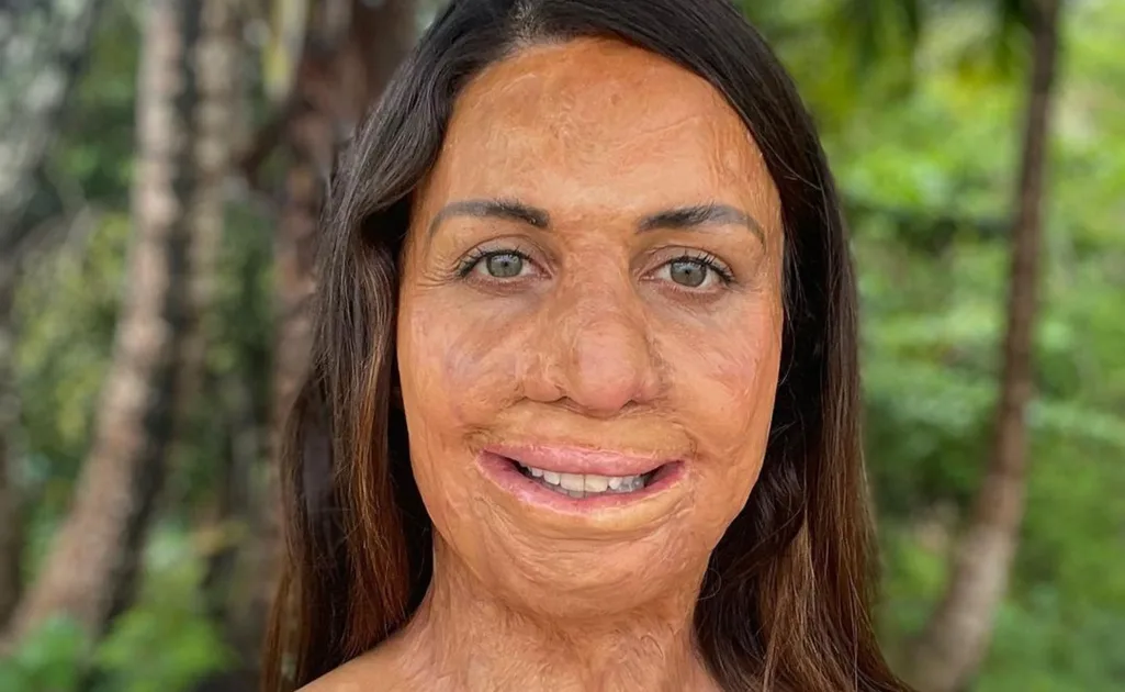 Turia Pitt on the "confronting" images taken days after fire