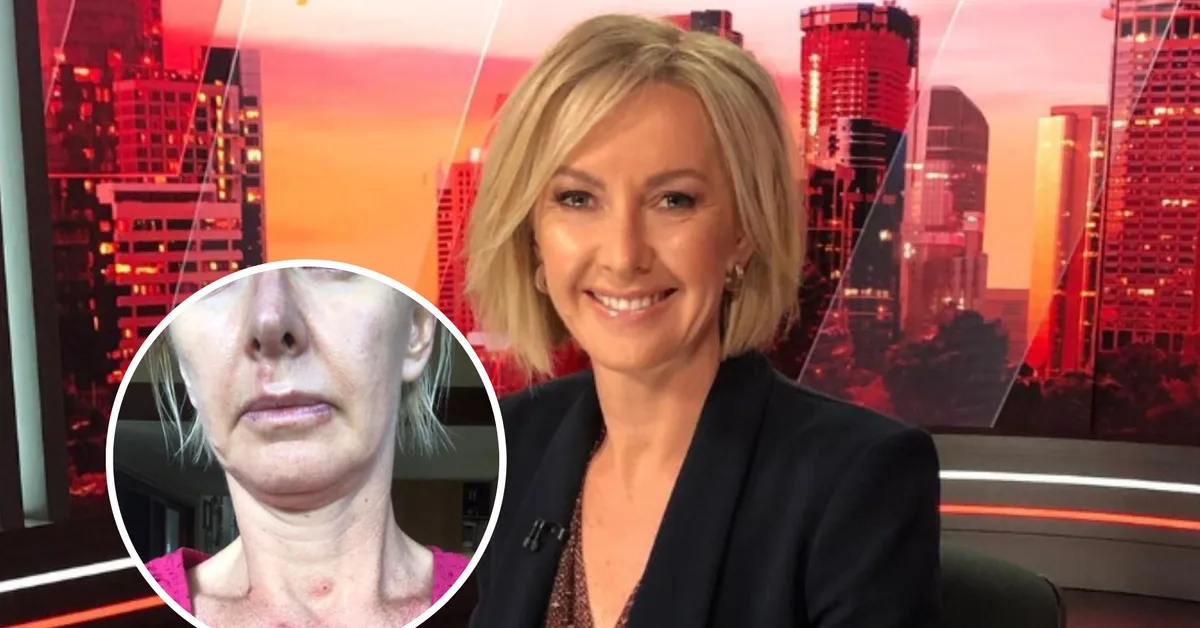 Deborah Knight's shocking Instagram of painful welts