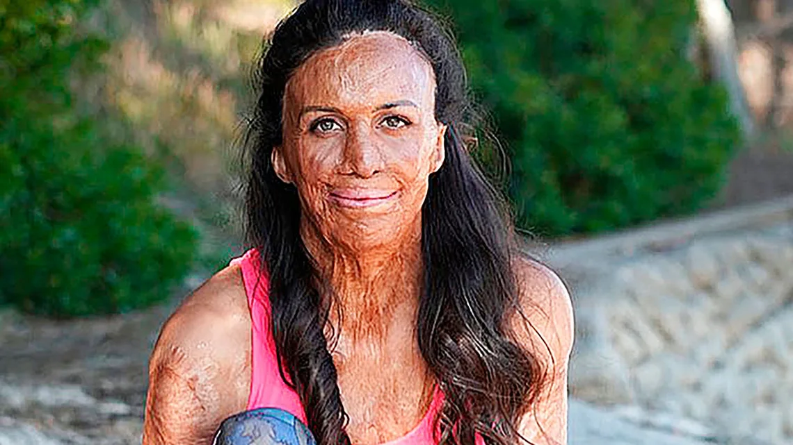 Burn victim Turia Pitt shares her incredible comeback