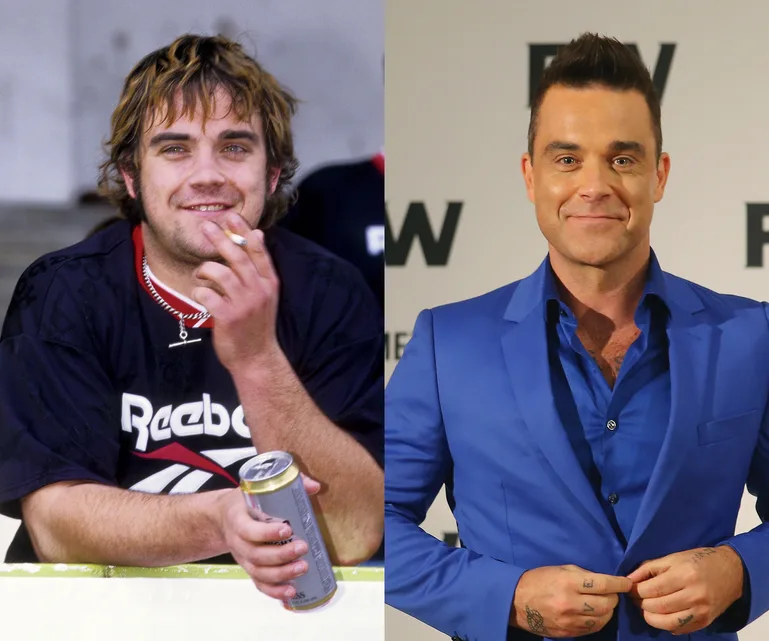 Robbie Williams plastic surgery confession