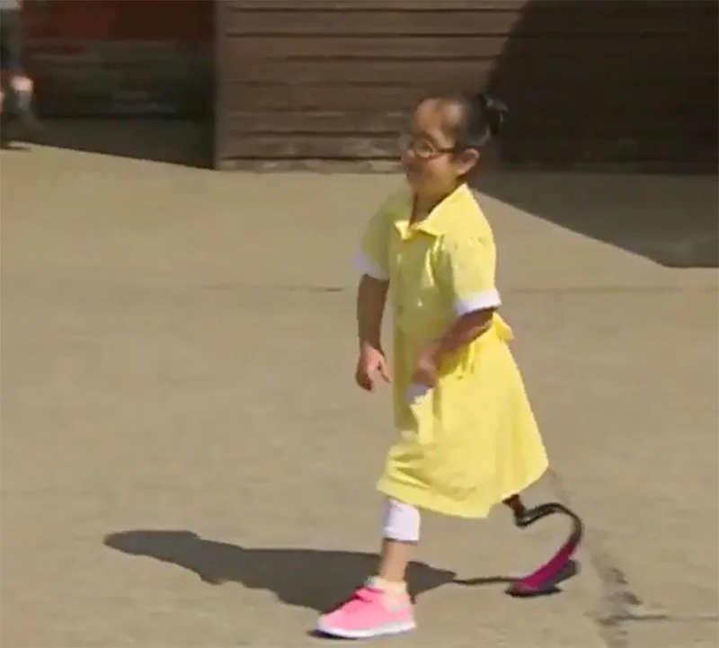 Girl shows friends school friends her new prosthetic leg for first time
